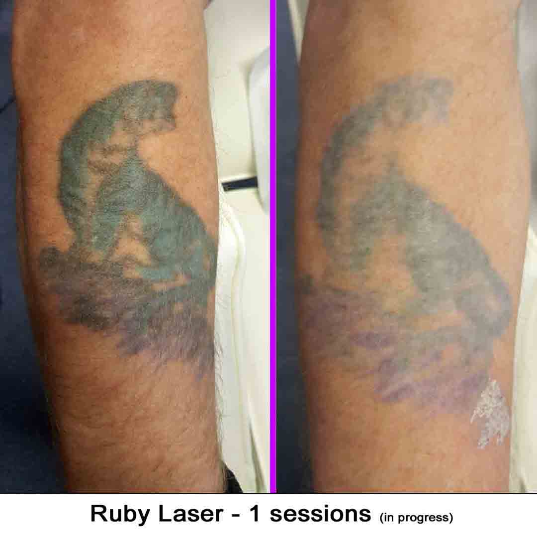 Tattoo removal before & after photos - Redeem Clinic - Hull - Yorkshire