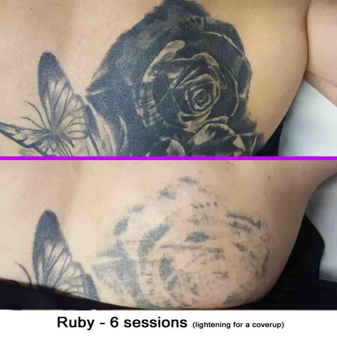 Tattoo removal before & after photos - Redeem Clinic - Hull - Yorkshire